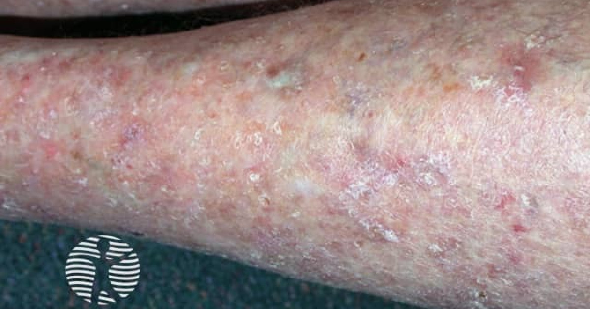Basal cell carcinoma affecting the arms and legs image