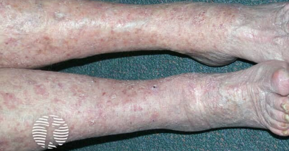 Basal cell carcinoma affecting the arms and legs image