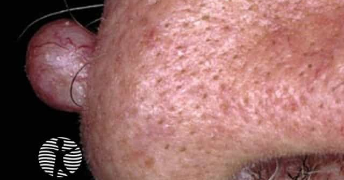 Basal cell carcinoma affecting the nose image