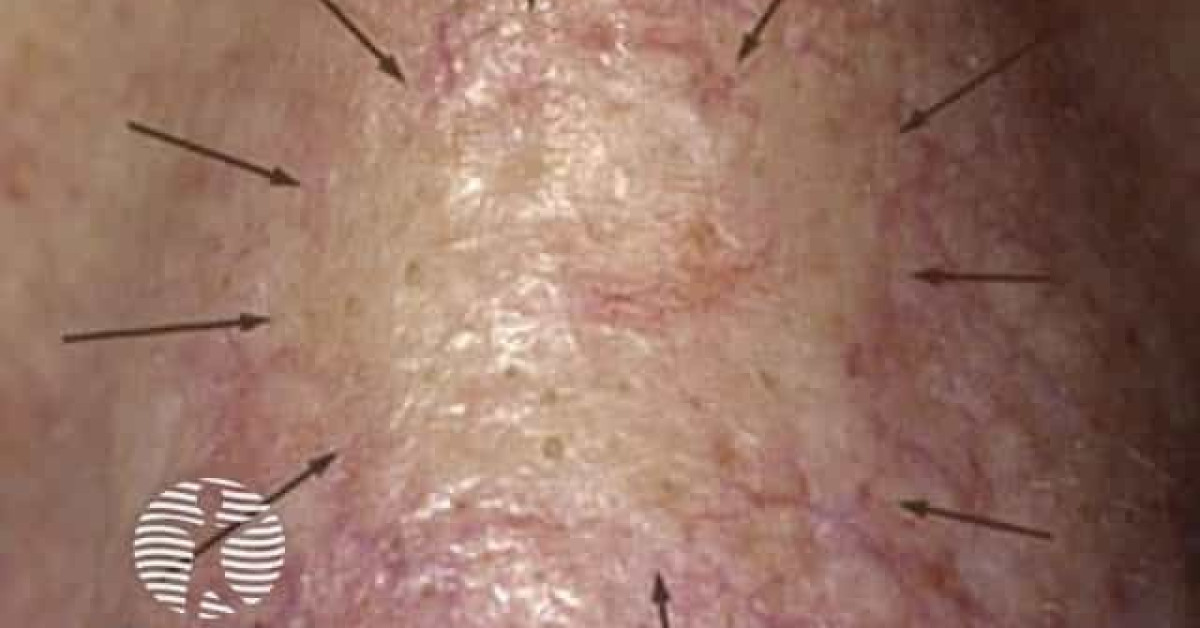 Basal cell carcinoma affecting the nose image