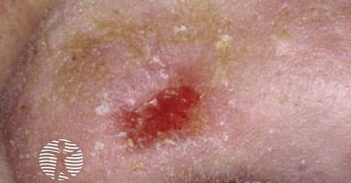 Basal cell carcinoma affecting the nose image