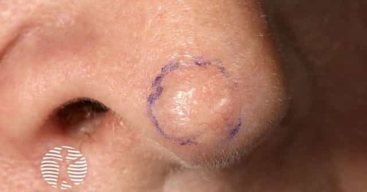 Basal cell carcinoma affecting the nose image