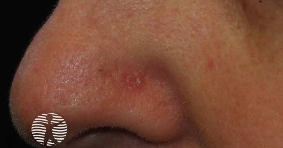 Basal cell carcinoma affecting the nose image