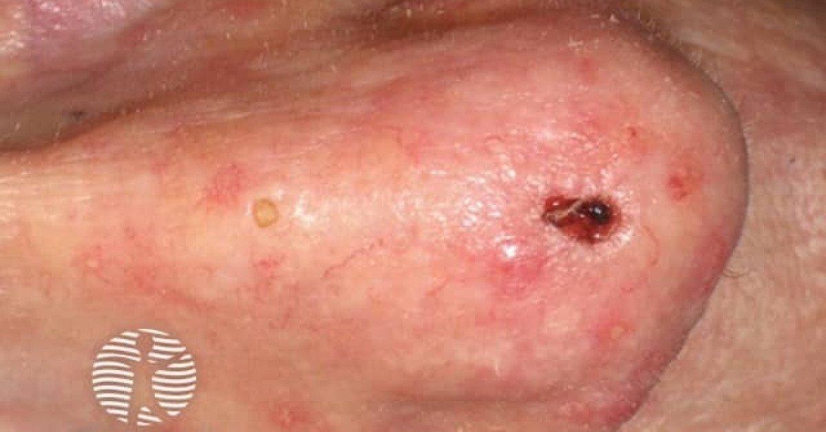 Basal cell carcinoma affecting the nose image