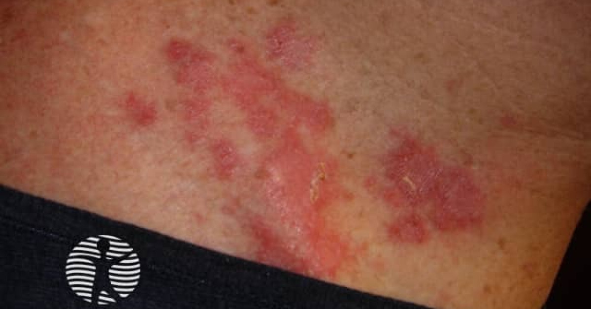 Basal cell carcinoma affecting the trunk image