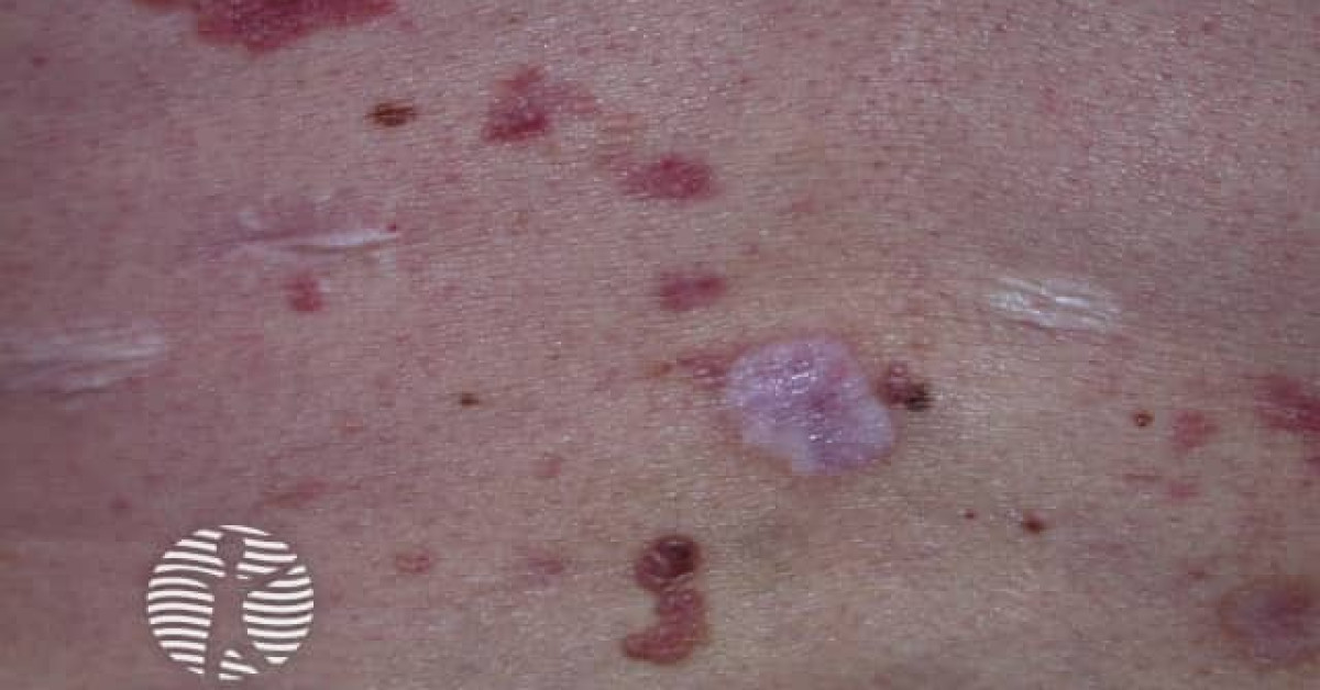 Basal cell carcinoma affecting the trunk image