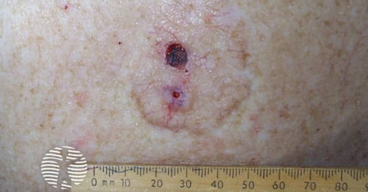 Basal cell carcinoma affecting the trunk image