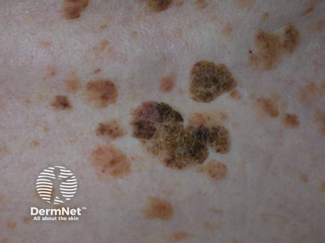 Lesion Tumour And Cancer Images Lesion Tumour And Cancer Images