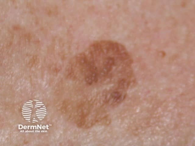 Seborrhoeic Keratoses brown Warts Basal Cell Papillomas Seborrheic Seborrhoeic Keratoses brown Warts Basal Cell Papillomas Seborrheic