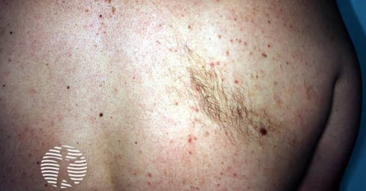 Beckers naevus image