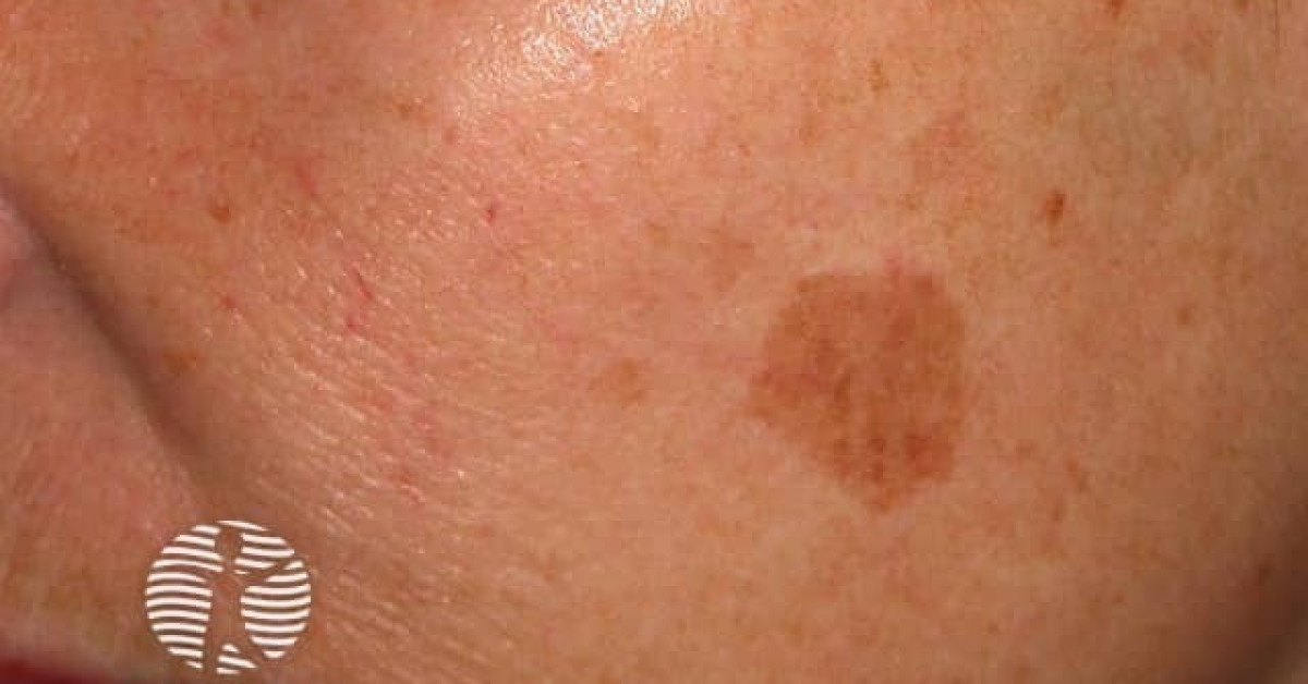 DermNet® - Freckle before cryotherapy image