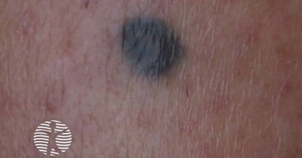 Blue naevus image