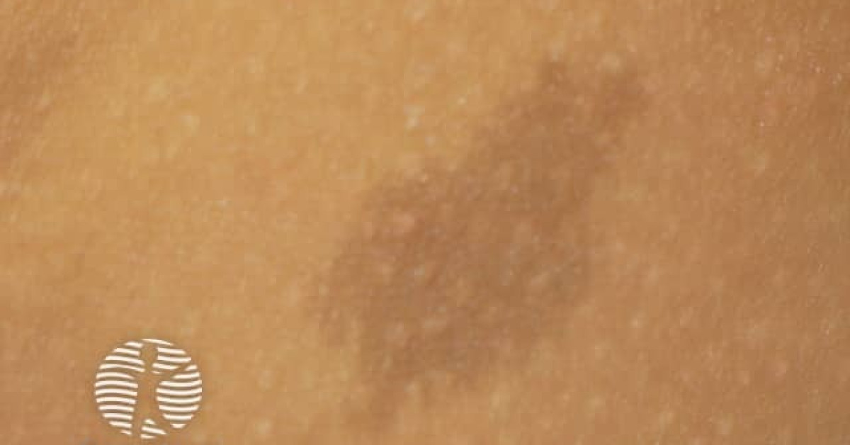 Cafe au lait macule image