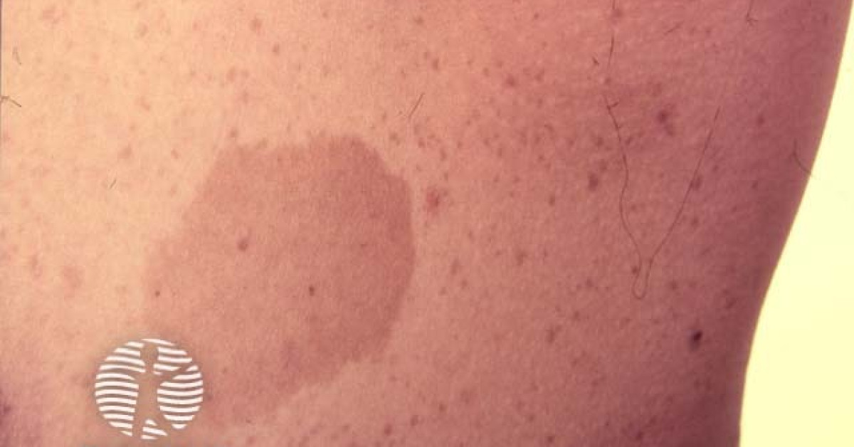 Cafe au lait macule image