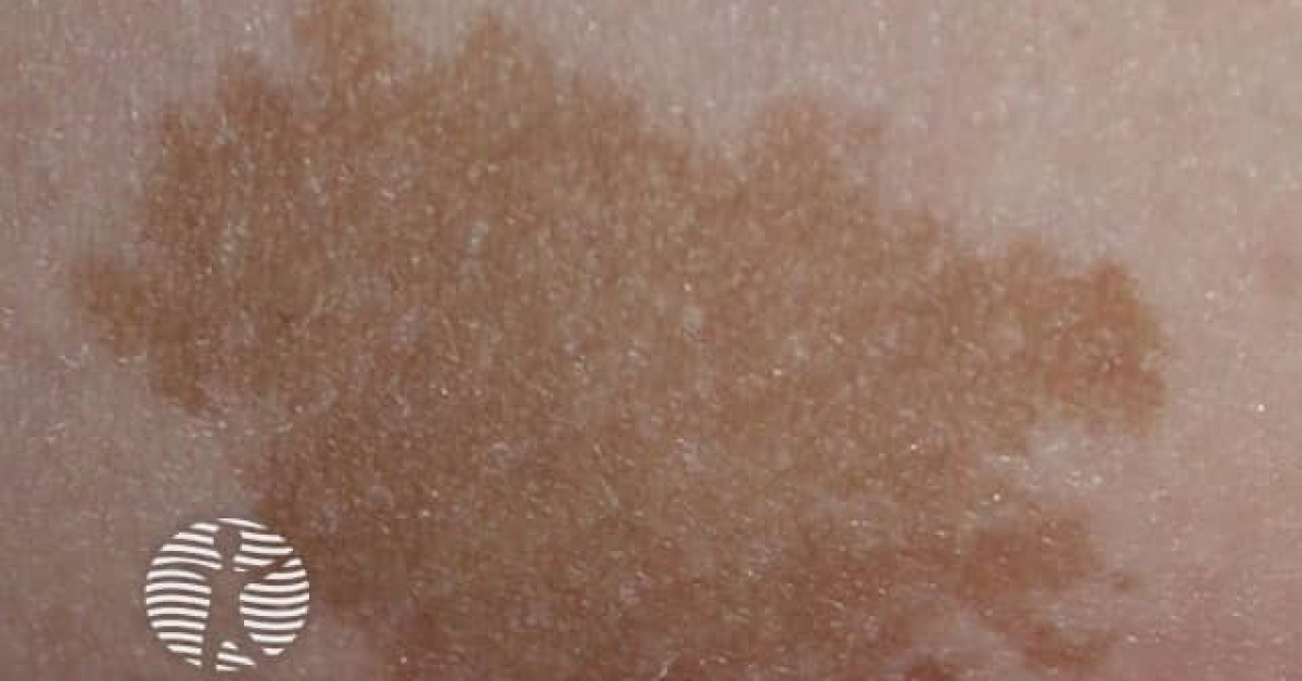 DermNet® - Congenital naevus image