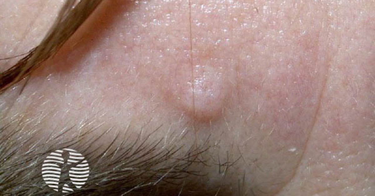 cellular naevus image