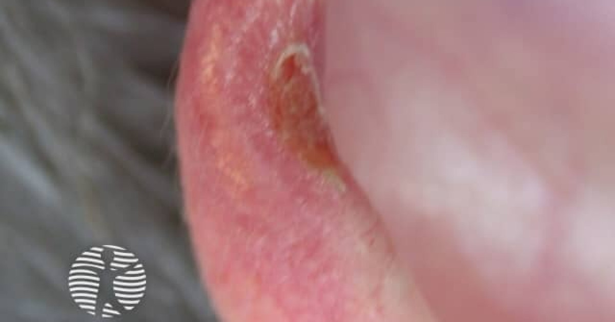 Chondrodermatitis image