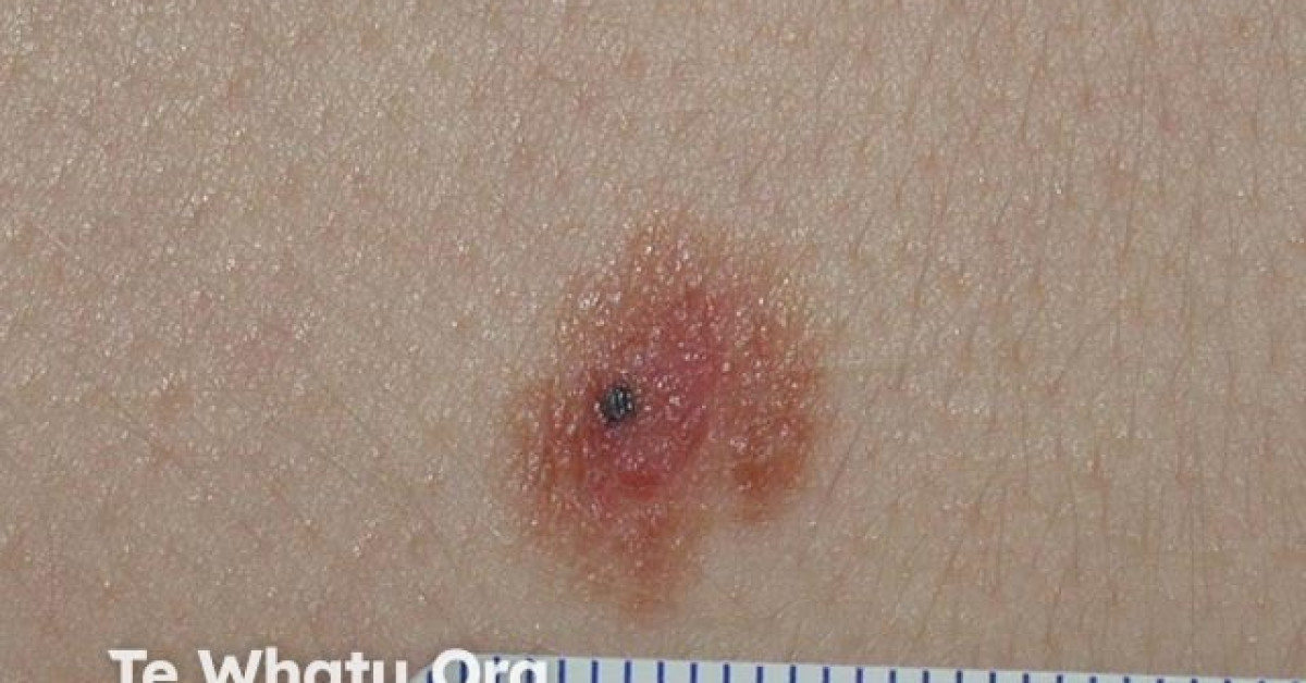 Combined naevus image