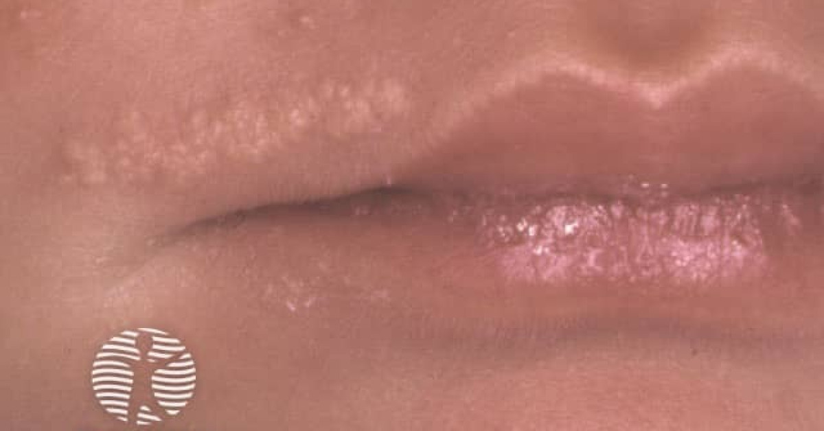 Connective tissue naevus image