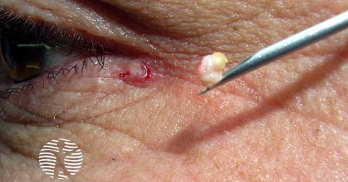 Cyst image