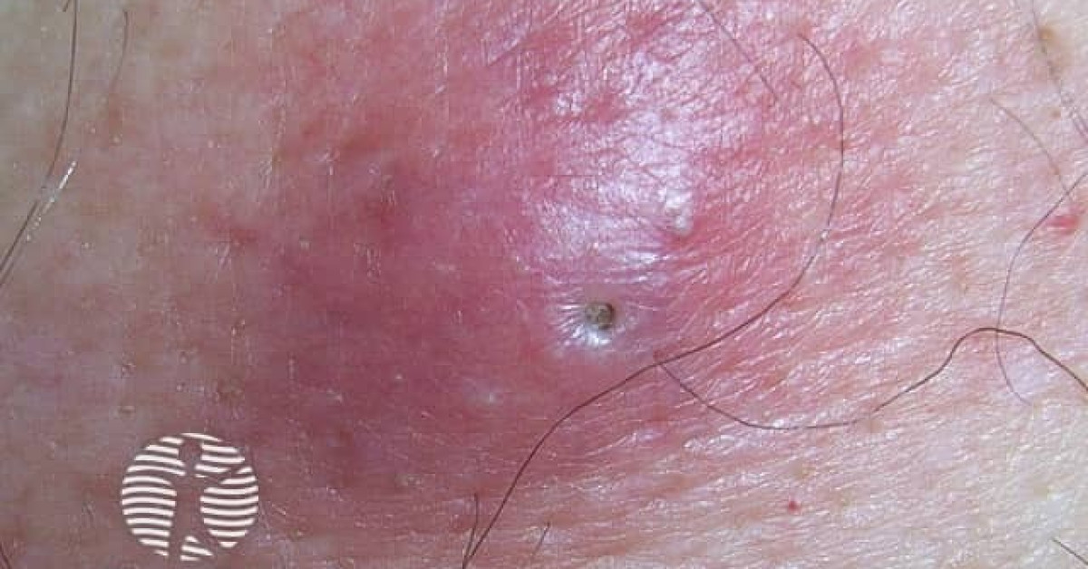 Cyst image