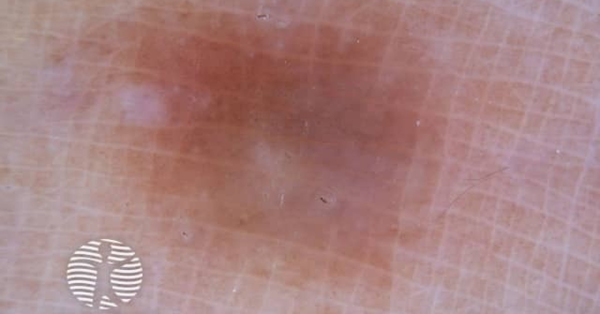 Dermatofibroma image