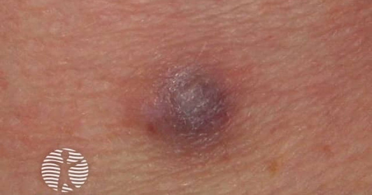 Dermatofibroma image