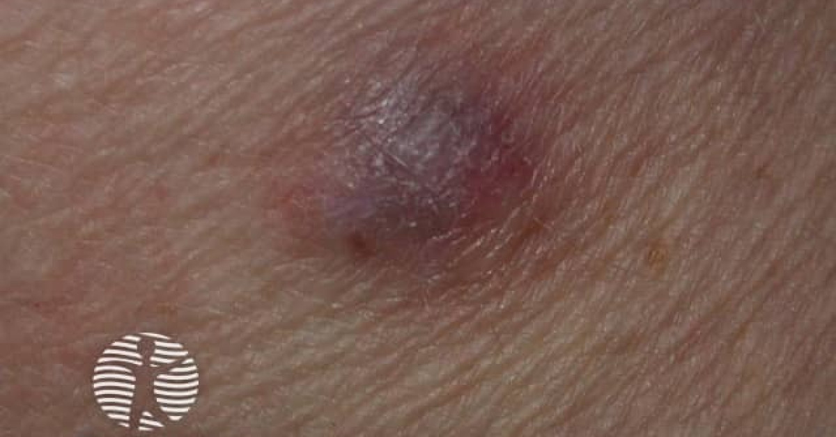 Dermatofibroma image