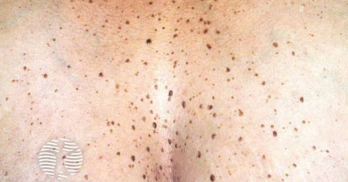 Dermatosis papulosa nigra image