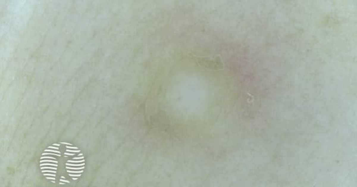 Dermatofibroma image