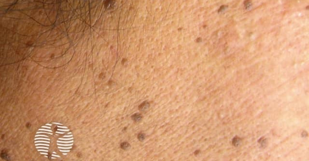 Dermatosis papulosa nigra image