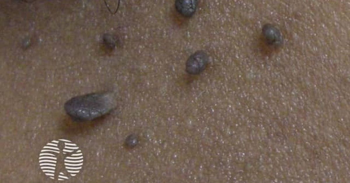 Dermatosis papulosa nigra image