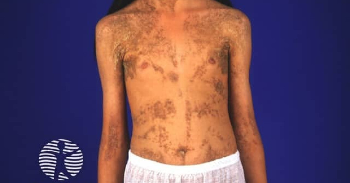 epidermal naevus image