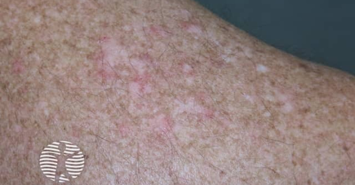 Eruptive lichenoid keratoses image