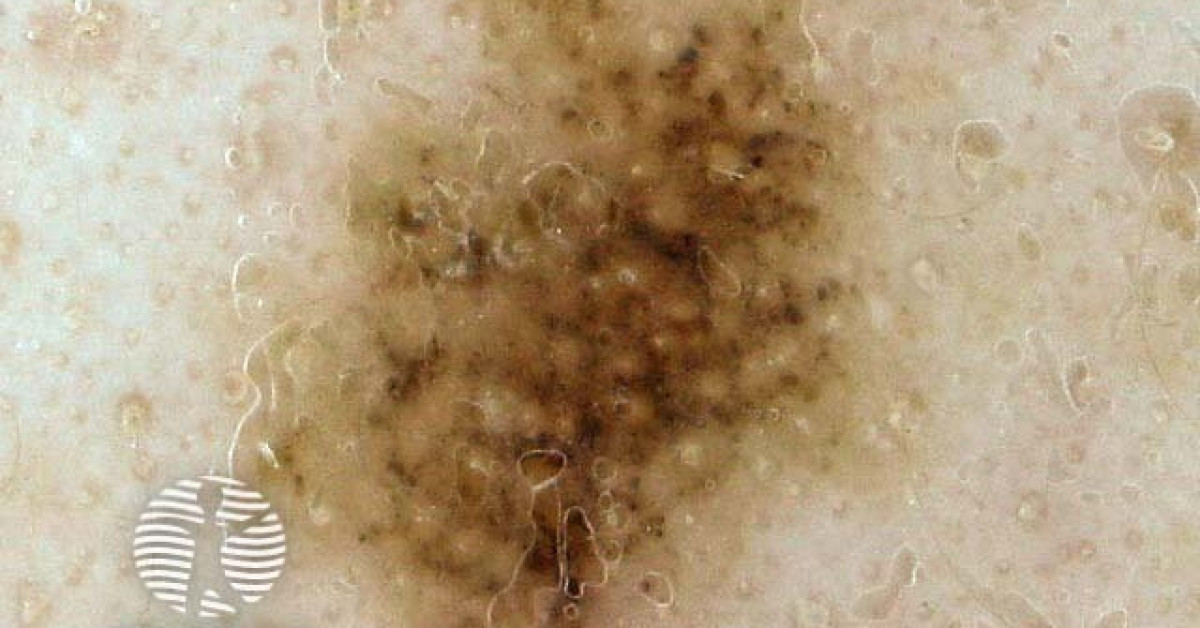 Dermoscopy of a naevus on the face image