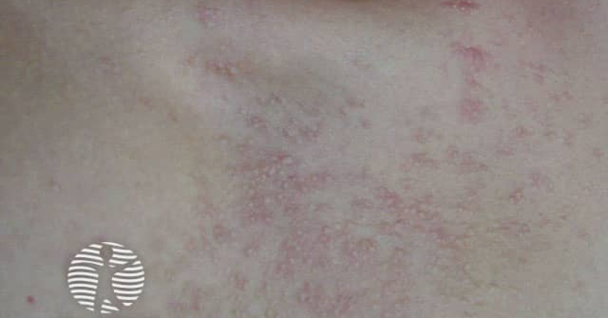 DermNet® - Fibrofolliculomas image