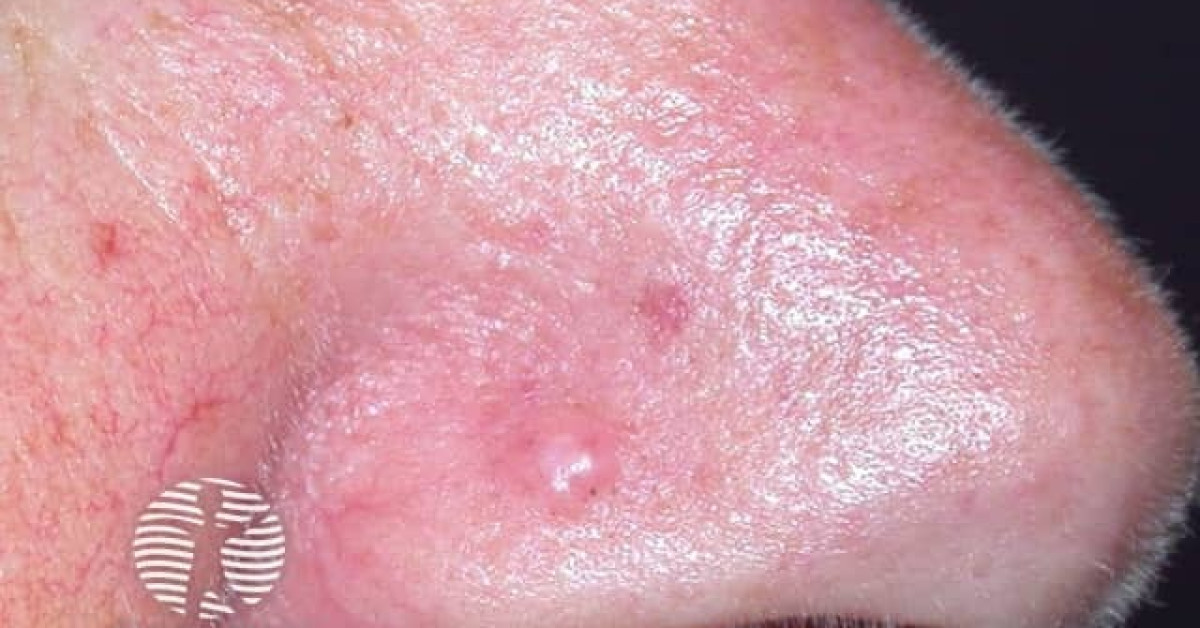 Fibrous papule of the nose image