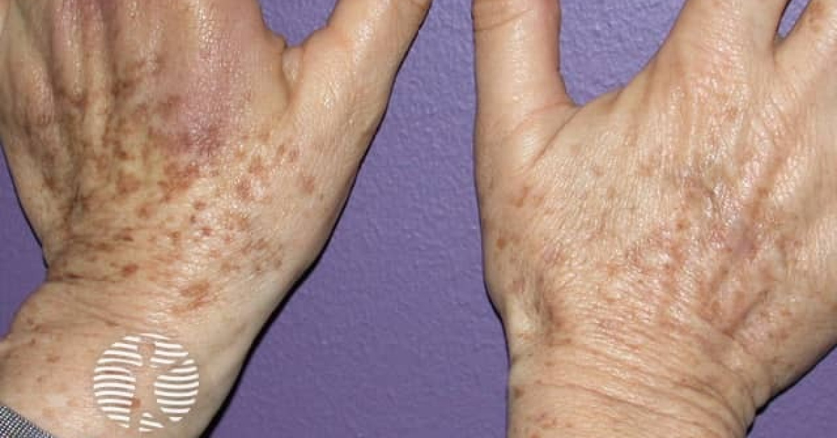 Freckles on hand before and after green laser light image