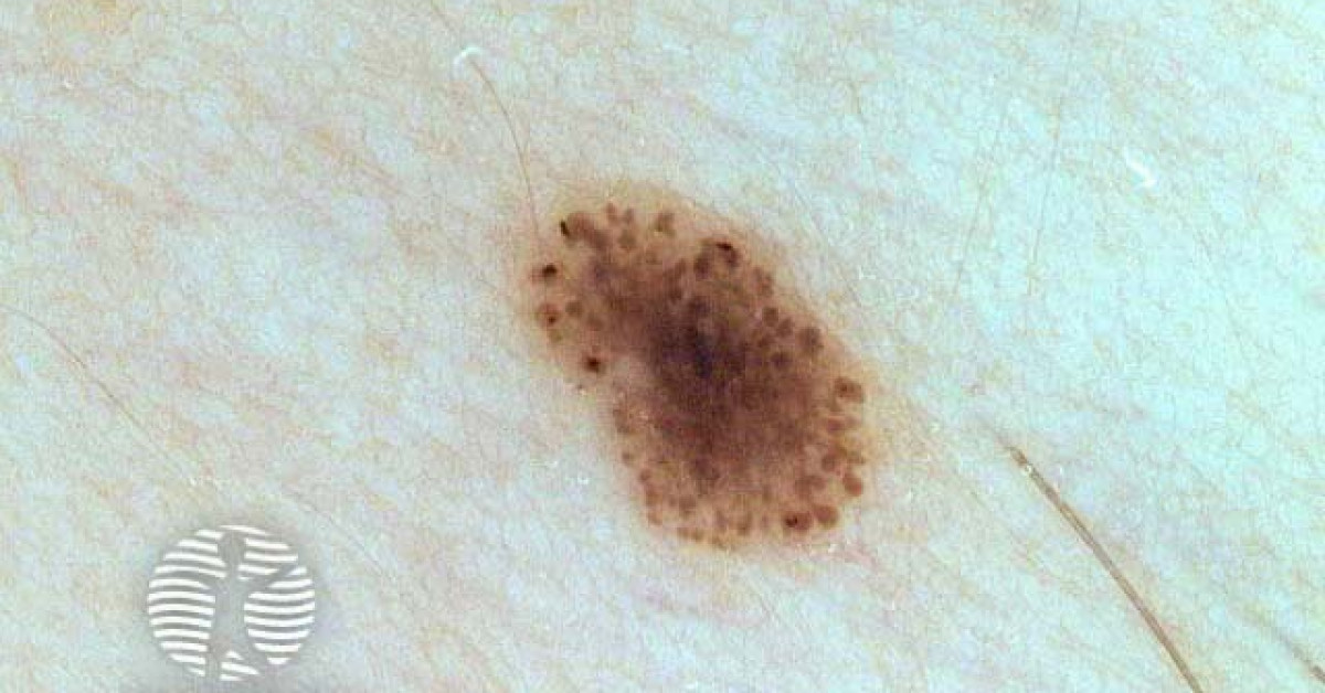 Globular naevus dermoscopy image