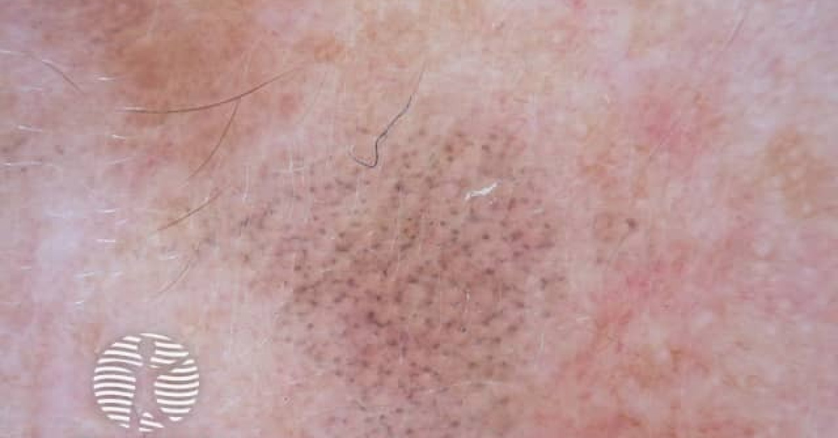 Annular granular pattern seen in dermoscopy of lichen planus-like ...
