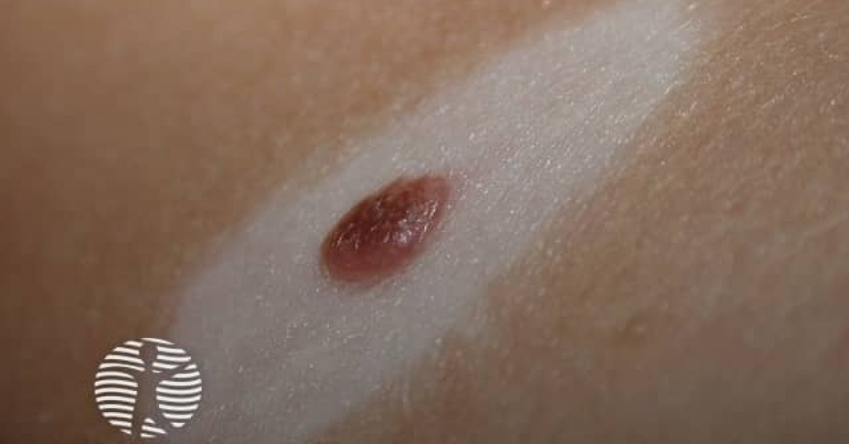 Halo mole image