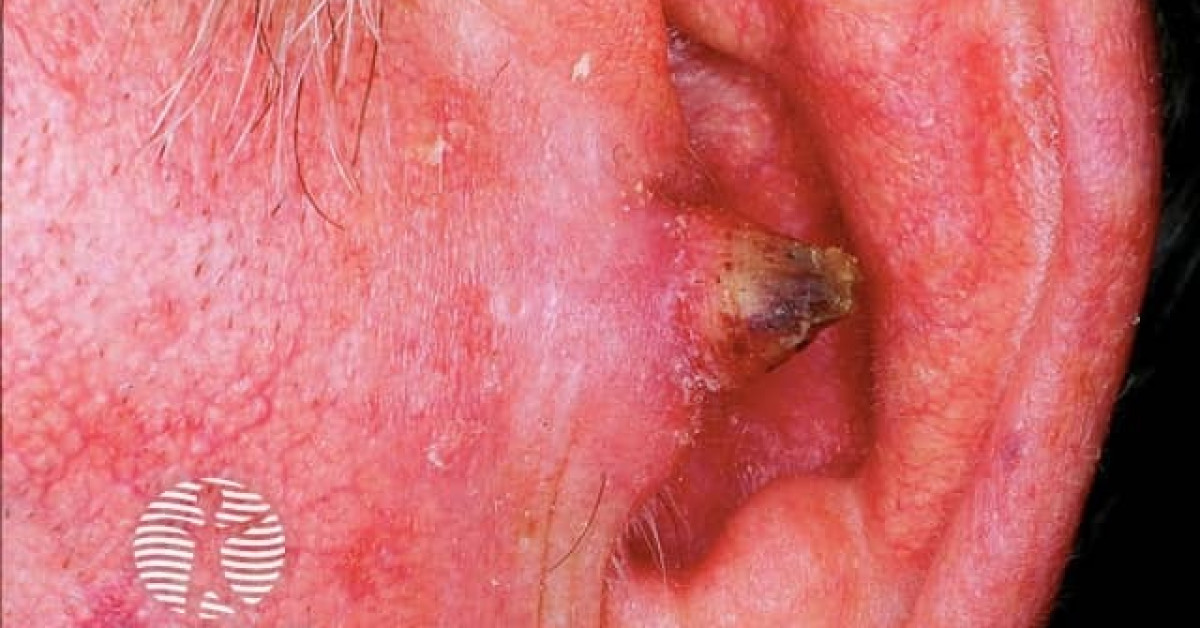 DermNet® - Cutaneous horn image
