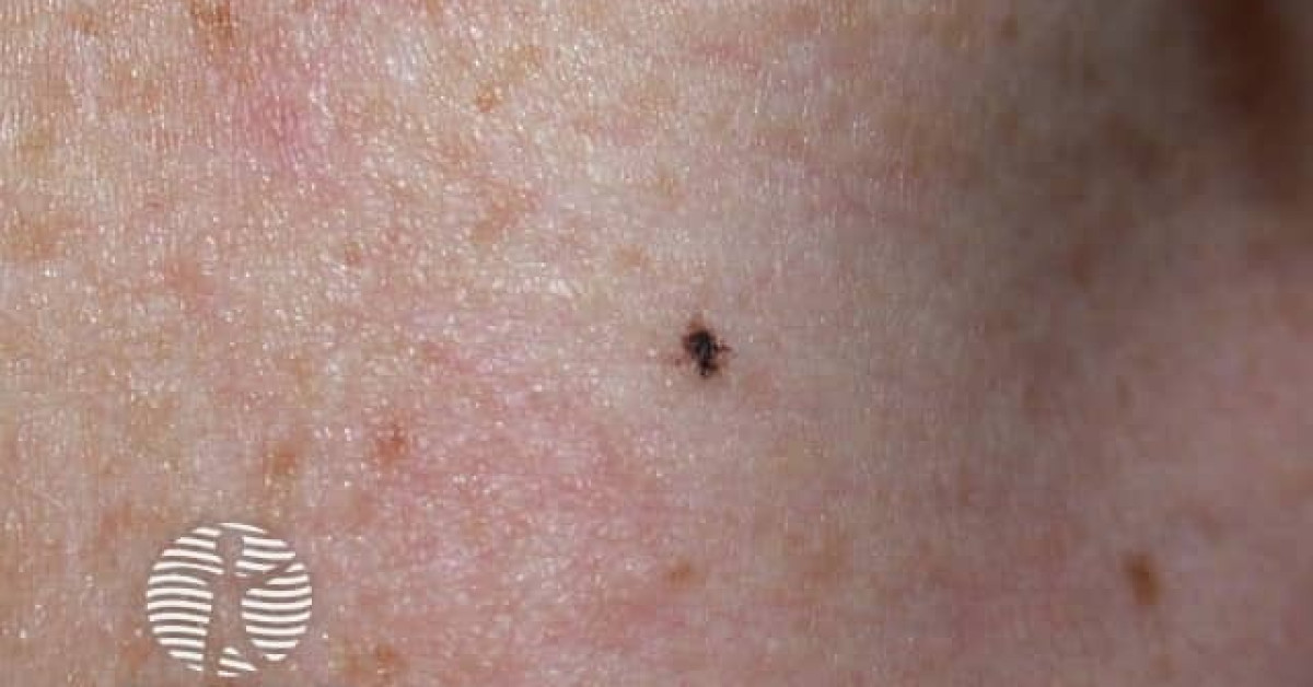 Ink spot lentigo image