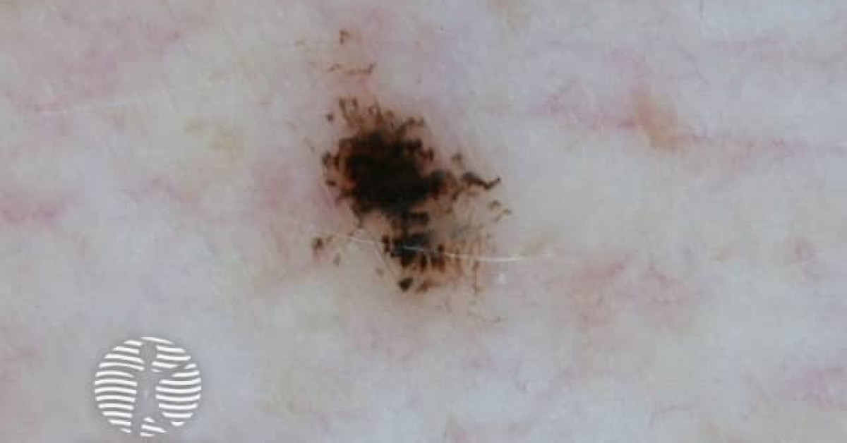 Ink spot lentigo dermoscopy image