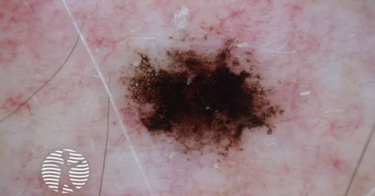 Ink spot lentigo dermoscopy image