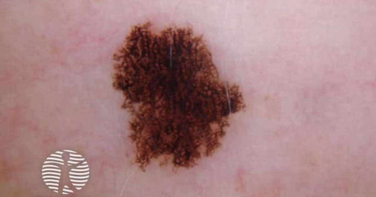 Ink spot lentigo dermoscopy image