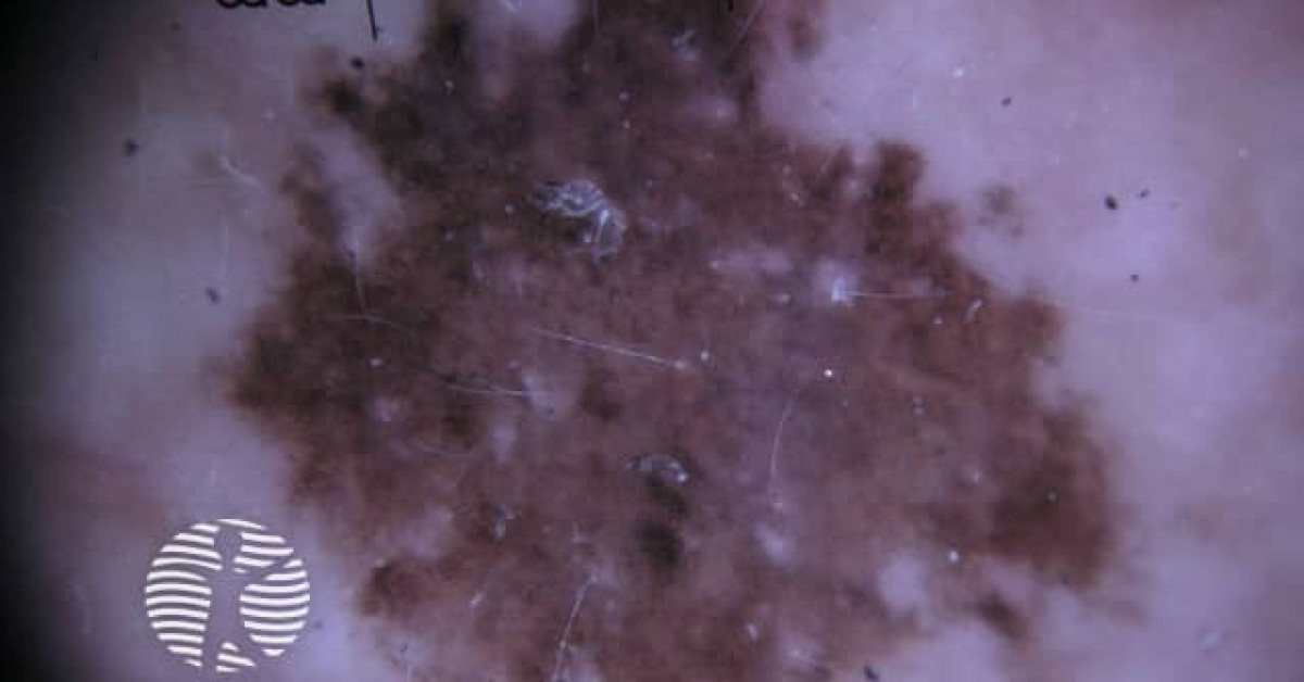 Ink spot lentigo dermoscopy image