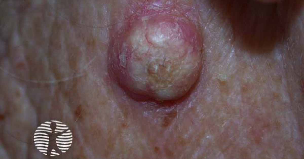 Keratoacanthoma image