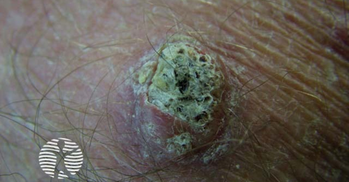 Keratoacanthoma image