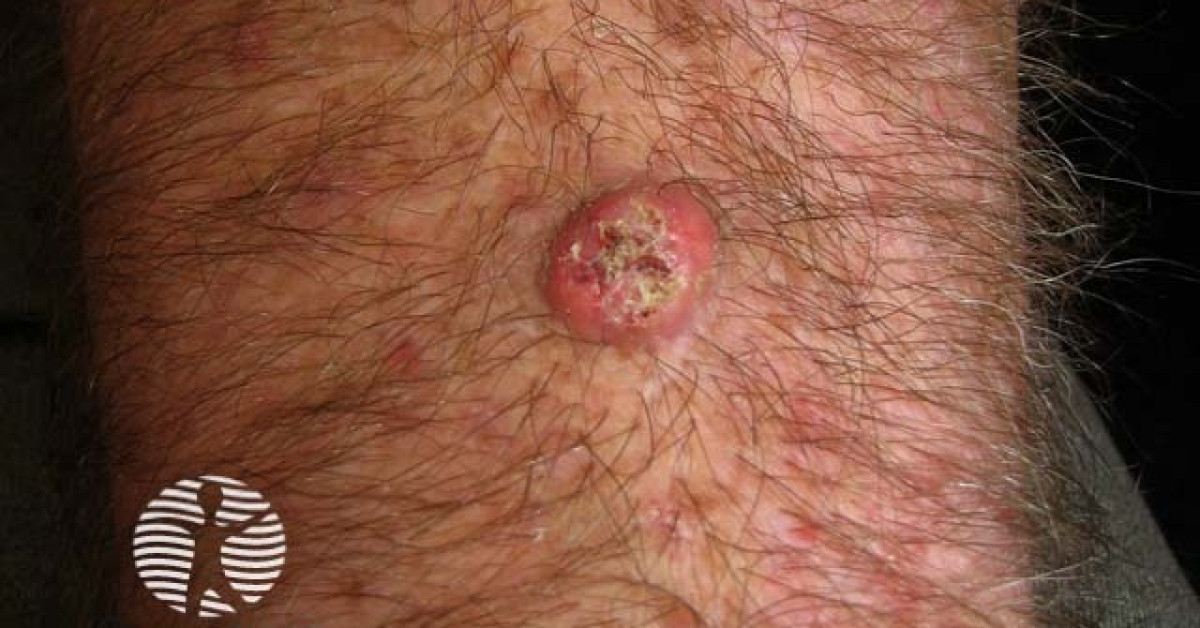 Keratoacanthoma image